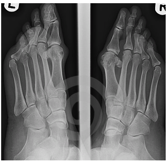 Ankle Fracture | Foot Fracture | Foot and Ankle Center