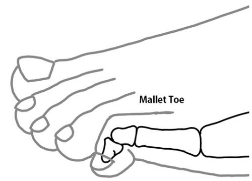 Hammertoe Treatment Guide | Seattle Specialists