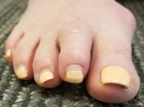 Plantar Plate Injuries - A Cause of Chronic Ball of Foot Pain | Foot ...