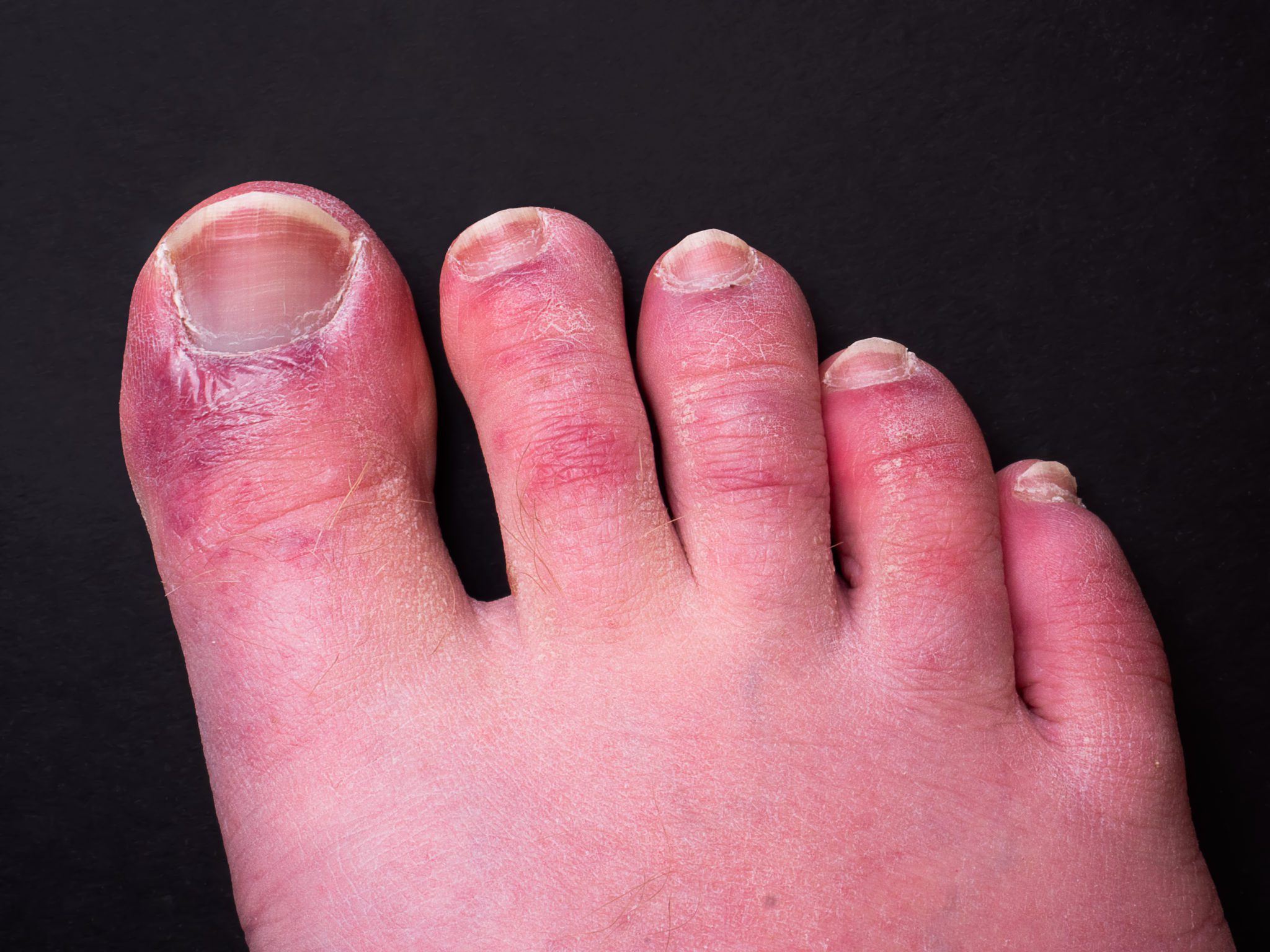 Painful, Red, Itching and Blistered Toes? It Might Be Chilblains | Foot ...